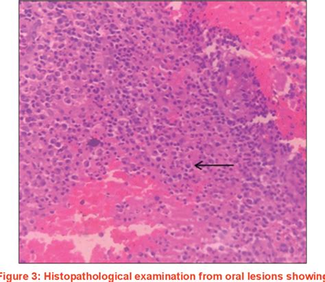 Mucous Patch Of Secondary Syphilis Masquerading As Leukokeratosis An