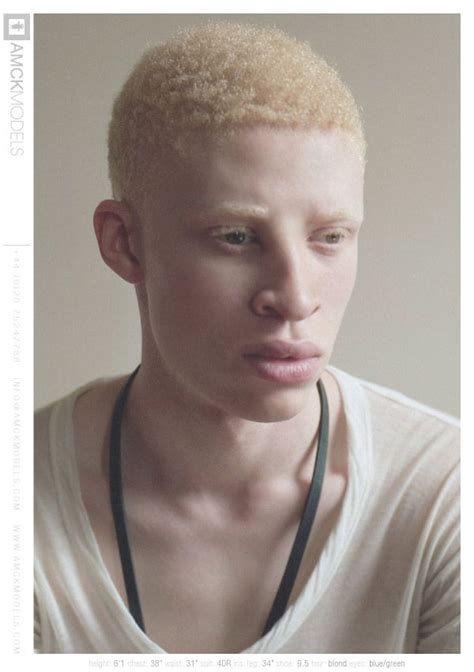 Albino Model Shaun Ross