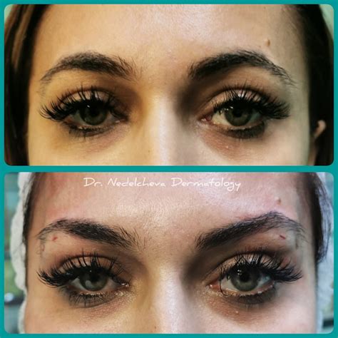 Лифтинг на вежди Дерматологичен център Д р Неделчева Facebook