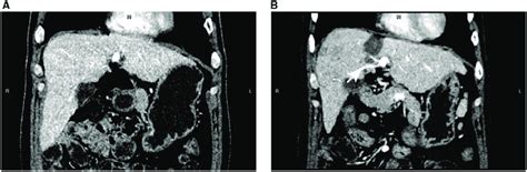 Contrast Enhanced Computed Tomography Images Show Intrahepatic Download Scientific Diagram