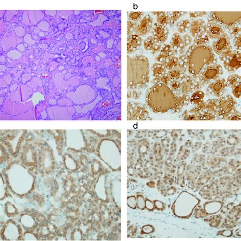 Tc 99 M Thyroid Scan Showed Diffusely Increased Uptake By The Thyroid