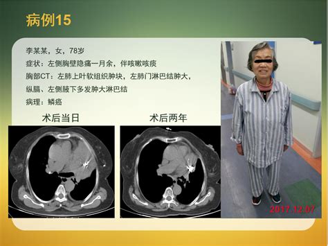 中晚期肺癌治疗肺I125粒子植入术后患者疗效评估 微医挂号网