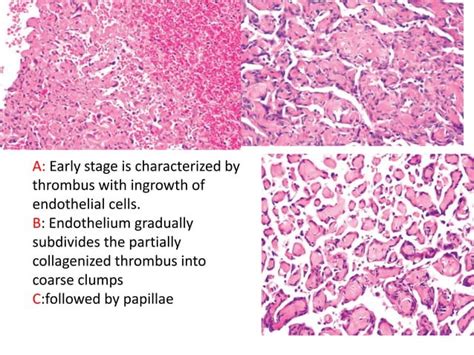 Pseudosarcoma Pptx