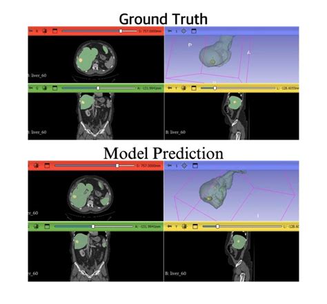 Ali Soultan On Linkedin Cuda Pytorch Clinicalinnovation Machinelearning Liverdisease