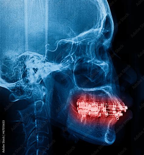 X Ray Scan Human For Teeth Stock Photo Adobe Stock