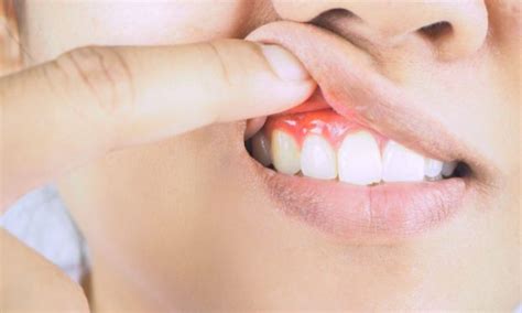 3 Signs Of Periodontal Disease Everyone Should Know