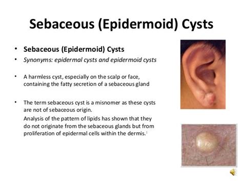 Dermoid And Epidermoid Cysts