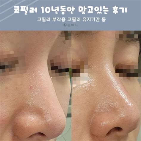 코필러후기 10년째 반복 시술 중 부작용 및 유지기간 네이버 블로그