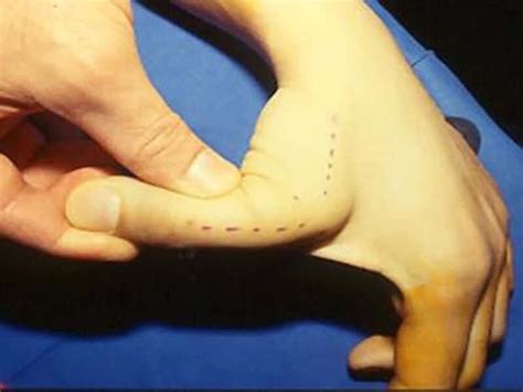 Entorse Du Pouce Traumatisme Des Doigts De La Main Pr Eric Roulot
