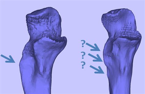 Ulna Supinator Crest