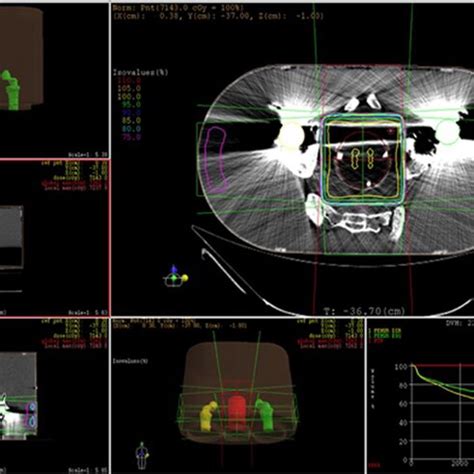 Screenshot Of The TPS Output For A Bilateral Prostheses Prostate Download Scientific Diagram