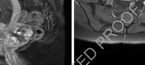 Mri Pelvis Showing An Enhanced Bunch Of Vascular Flow Void Size ~53 8 Download Scientific
