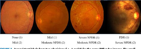 Figure 1 From Grading Of Diabetic Retinopathy Images Based On Graph Neural Network Semantic