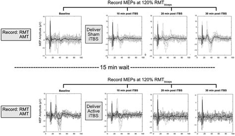 Tms Sessions And Empirical Data Before Application Of Itbs Single