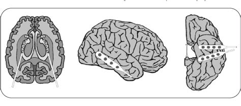 Figure 1 From Epileptic Seizure Detection In Eeg Signal Using Emd And Entropy Semantic Scholar