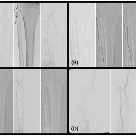 Case 1 A An Asahi Mongo Wire Crosses A Total Occlusion Of The Right Download Scientific