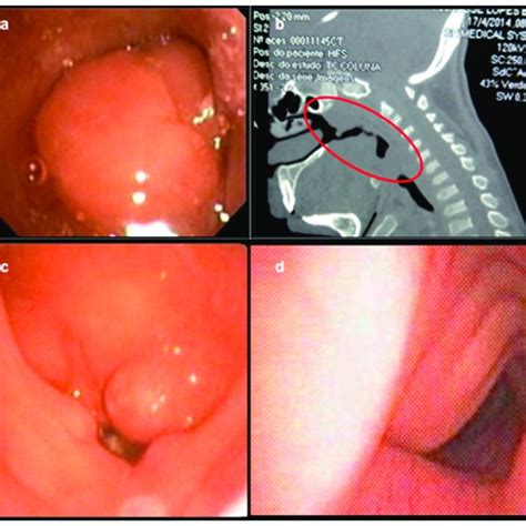 Abnormal Findings In The Esophagus During Transnasal Esophagoscopy A