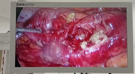 Cirbosque Some4surgery On Twitter Rt Amendozazuchini W39yo Ct