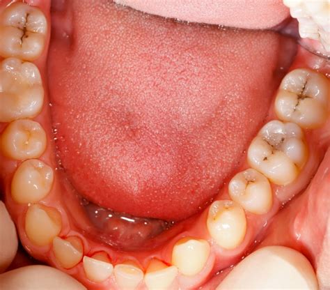 3 Common Signs Of Cavities Greenspoint Dental Houston Dentist