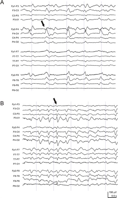 Diagnosing And Monitoring Seizures In The Icu The Role Of Continuous