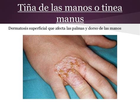 Dermatofitosis