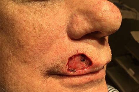 Mohs Surgery Procedure Gallery Baucom And Mina Derm Surgery Llc