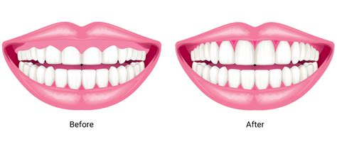 Gum Contouring Kansas City Mo Gum Contouring Gum Reshaping Cosmetic
