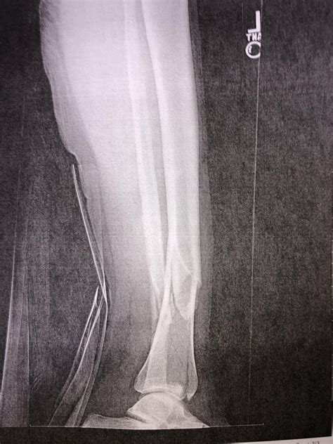 Here My Pre Op Tib Fib Fracture 11 Weeks Ago Vs Today R Xrays