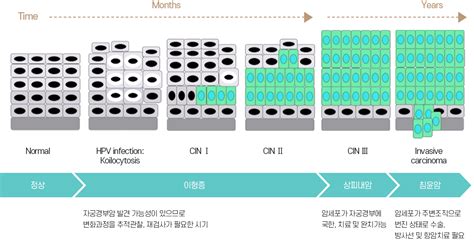 자궁경부암 레아산부인과