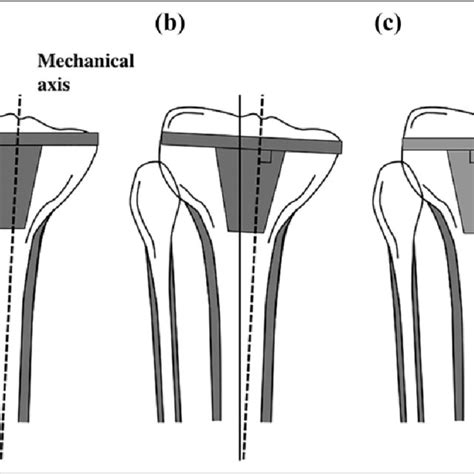 A A Tibial Component Is Set Perpendicular To Anatomical Axis B A Download Scientific