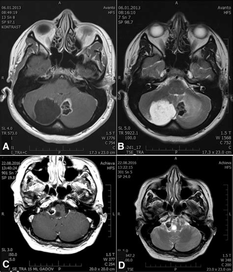 A Case 4 The Calcified Mass Was Hypointense On T1 Mri Sequence B Case Download Scientific