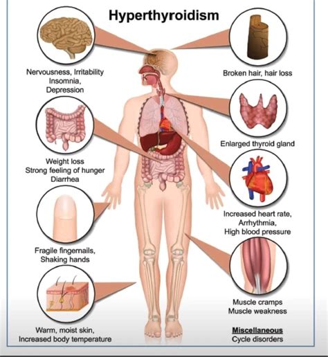 Hyperthyroidism Over Active Thyroid Hormone Dr Tarun Shukla Posted