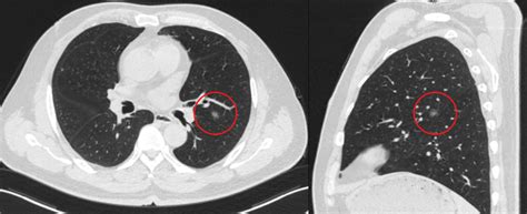 Ground Glass Opacity In The Left Lingular Segment In The Internal 13 Download Scientific