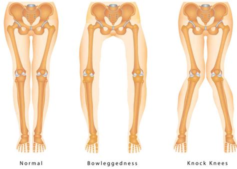 Legs Bent Inward At The Knee