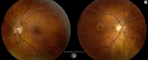 Venous Loop Retina