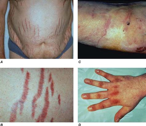 Disorders Of Sex Development Basicmedical Key