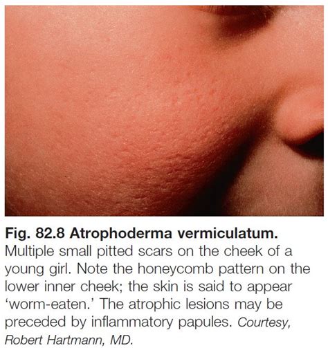 Atrophoderma Vermiculatum
