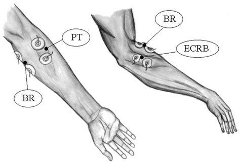Electrode Placement For The Br Ecrb And Pt With The Forearm Supine