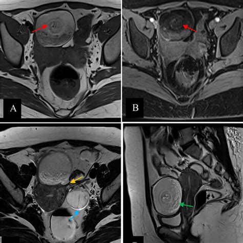 T1 Weighted Axial Plane A And T1 Fat Saturated B Showed Fat Fluid
