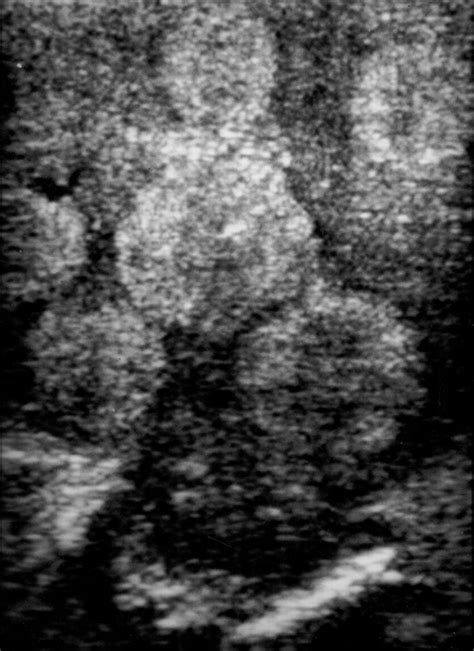 Echinococcus Multilocularis Revisited Ajr