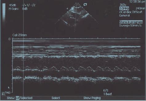 The Importance Of Echocardiography In The Diagnosis Of Atrial Flutter