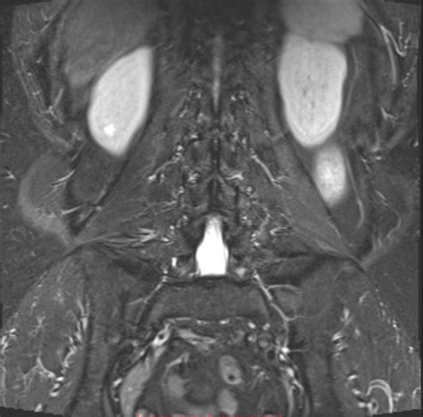 Iliolumbar Ligament Mri