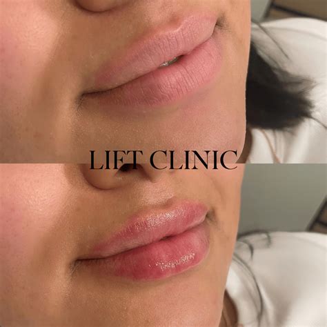What Does 1ml Of Lip Filler Look Like 1ml Lip Fillers Before And After