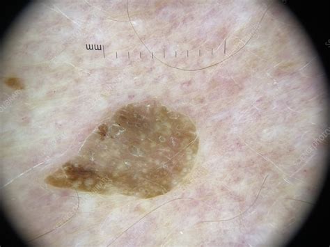 Seborrheic Keratosis Dermoscopy Stock Image C0572324 Science