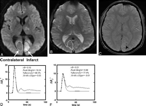 A A 40 Year Old Male Patient With Ais Visible As Hyperintensity On