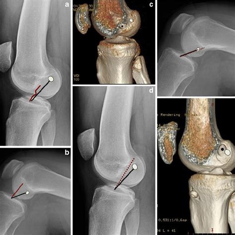 A Front View Of A Radiograph The Angle Of The Tibial Tunnel When A Front View Of A Radiograph The Angle Of The Tibial Tunnel When