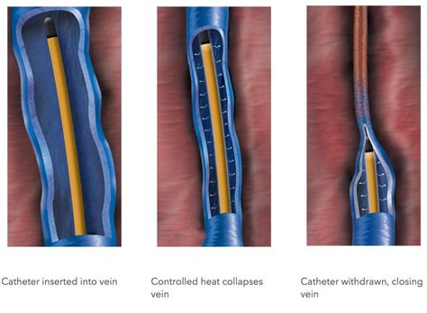 What To Do When Veins Collapse