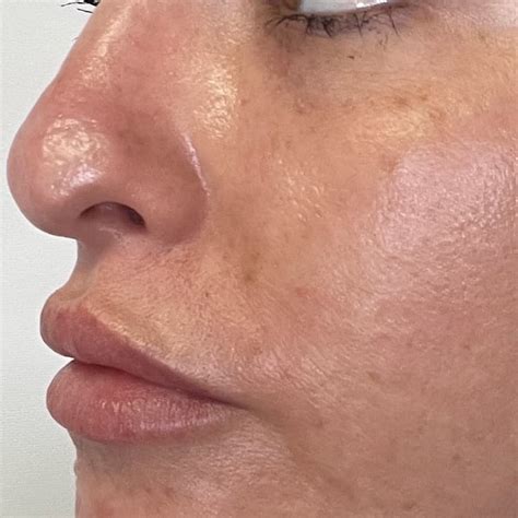 Co2 Laser Before And After Newtown Rejuvenation Medical Aesthetics