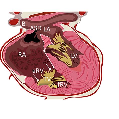 The Carpentier Classification Of The Tricuspid Valve With Progressive Download Scientific