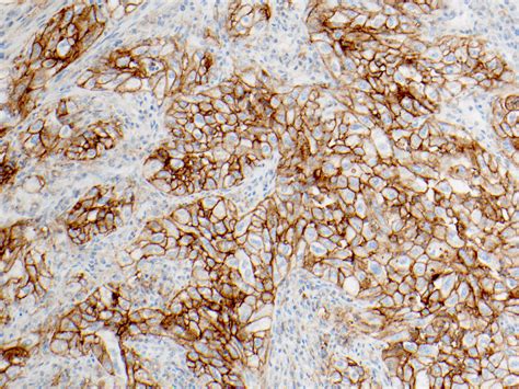 Thoracic And Head And Neck Pathology Anatomic Pathology Urmc Clinical Labs University Of